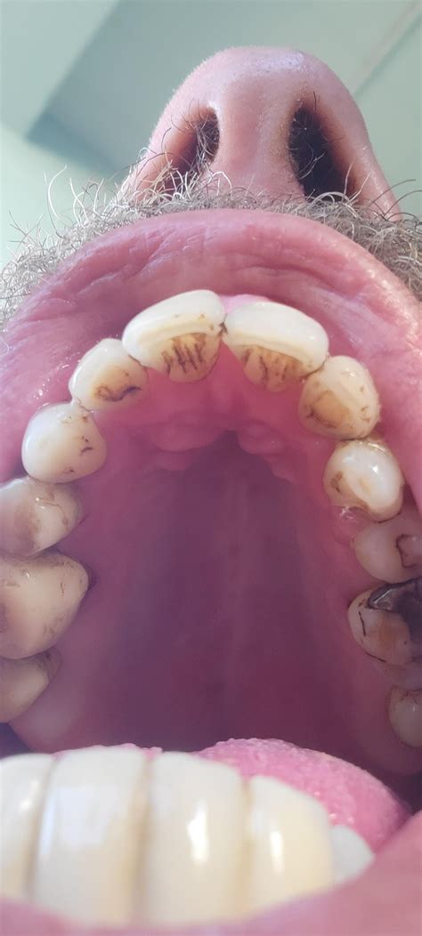 My Palate Side Seems To Be Uneven And Missing A Piss Almost Crater Like Not Like That On The