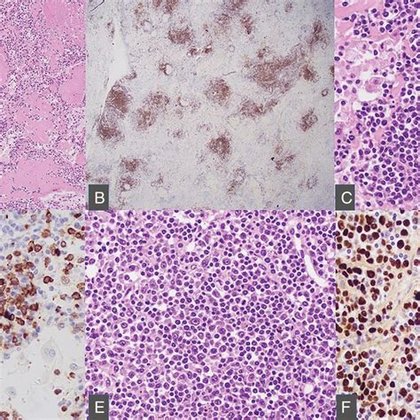 Case 2 Histopathology Of Post‐mortem Lung A Lung Parenchyma With