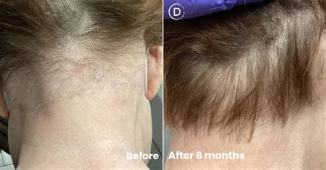 Overcoming Alopecia Areata In Ophiasis Pattern In The 70s Dermatology Circle