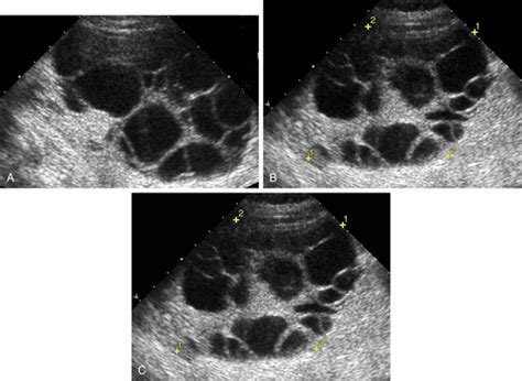 Theca Lutein Cyst Clinical Gate