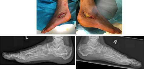 Clinical And Radiological Images Following Of The Bone And Soft Tissue