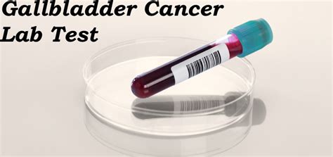 Gallbladder Cancer Treatment Cost In India From Best Doctor