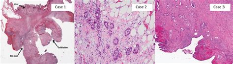 Cholangio Conundrum A Case Series Of Painless Jaundice Case Reports