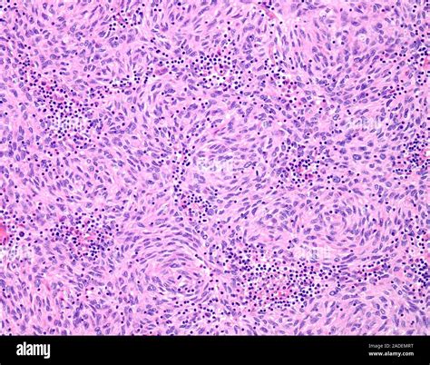 Follicular Dendritic Cell Sarcoma Light Micrograph The Tumour Is Composed Of Uniform Spindled