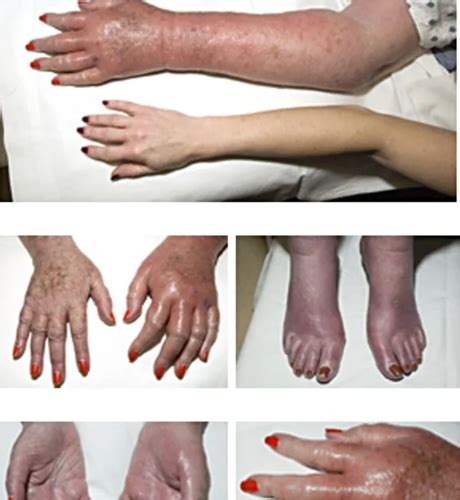 Osmosis 4 Polycythemia Vera Flashcards Quizlet