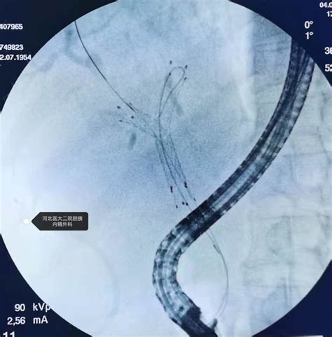 分享一例ercp胆道支架置入术 胆胰内镜网