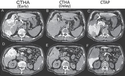 Figure 5 From A Case Of Cholangiolocellular Carcinoma Diagnosed After Liver Biopsy And Treated