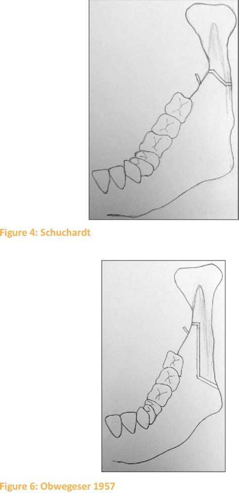 Figure 4 From Bilateral Sagittal Split Osteotomy A Versatile Approach For Correction Of Facial