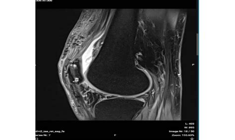 Post Operative Mri Notice The Improvement Of The Patellar Height And