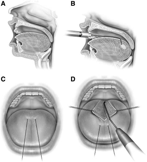 Lingual Tonsillectomy And Midline Posterior Glossectomy For Obstructive
