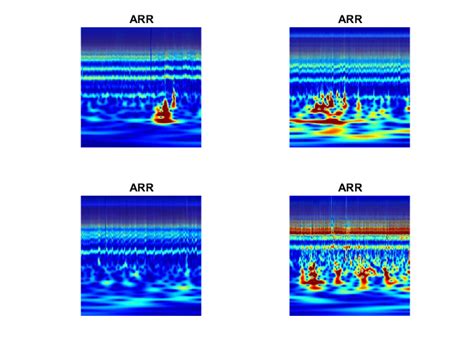 基于深度学习的心电信号（ecg）识别（matlab r2021b） 知乎