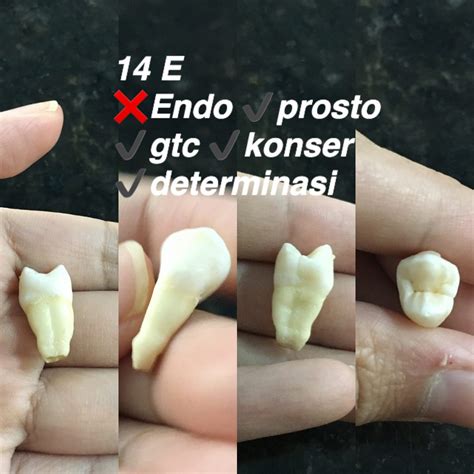 Jual Gigi Permanen Premolar 1 Atas 14e Jualgigicom