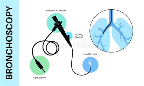 Bronchoscopy Procedure Concept Stock Vector Illustration Of Pneumothorax Biopsy 280635564