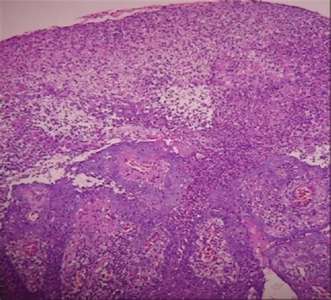 Cerebriform Cutaneous Lesions In Pemphigus Vegetans Pmc