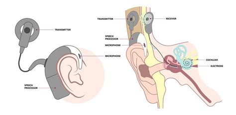 Cochlear Implant Evaluation North Georgia Audiology