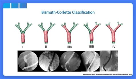 Bismuth Corlette Classifying Hilar Cholangiocarcinoma Klaus Mönkemüller