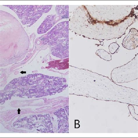 A Papillary Endothelial Hyperplasia Composed Of Some Papillary