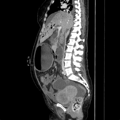 Fileesophageal And Gastric Pneumatosis Portal Venous Gas Radiopaedia 93811 112294 Sagittal 23