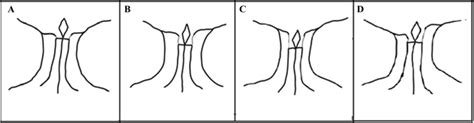 Keros Classification 15 Of The Height Of The Olfactory Fossa A Type