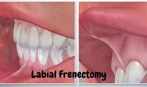 What Is A Labial Frenectomy And What Do You Need To Know