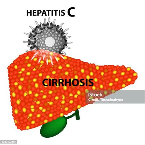 C 형 간염의 경우 97에서 간 경 변의 개발을 리드 인포 그래픽입니다 격리 된 배경에서 벡터 일러스트 레이 션 0명에 대한 스톡 벡터 아트 및 기타 이미지 Istock
