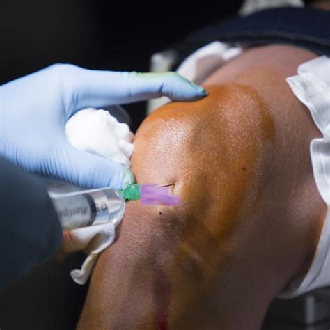 Joint Injections Advanced Rheumatology