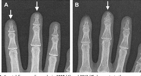 Scleroderma Hands Xray