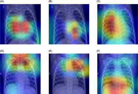 Figure From Pneumonia Detection In Chest X Ray Images Using An Ensemble Of Deep Learning