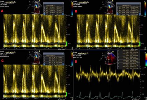 Diastolic Function In Patient With Af American College Of Cardiology