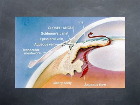 Ppt Acute Glaucoma Conditions Powerpoint Presentation Free Download