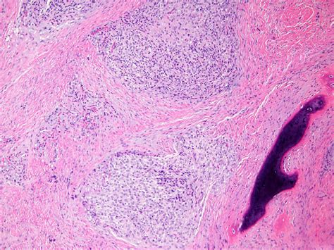 Pathology Outlines Ossifying Fibromyxoid Tumor