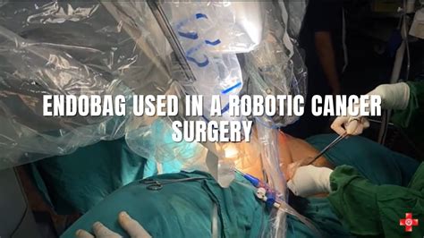 Morrisons Endobag Used In A Robotic Cancer Surgery Youtube