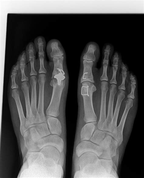 What Can Be Done For A Failed Joint Replacement In A Big Toe Foot And