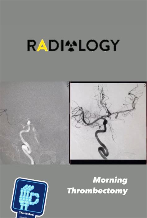 Radiology Interventionalradiology Neuroradiology Dsa Angiography Dr Med Theodor Lutz