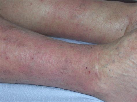 Eczema Gravitational Eczema