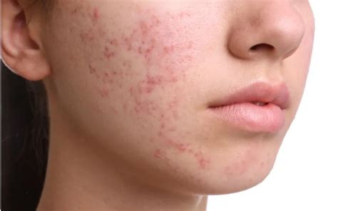 What Is The Best Acne Scars And Pores Treatment Kowayo Aesthetic