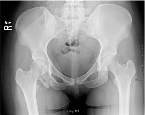 Figure 1 From Chronic Ten Years Ischial Tuberosity Avulsion Fracture