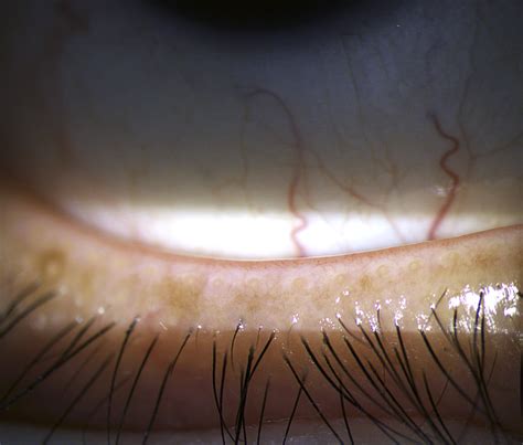 Intraductal Meibomian Gland Probing And Its Efficacy In The Treatment