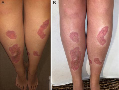 A Well Circumscribed Erythematous Atrophic Telangiectatic Plaques