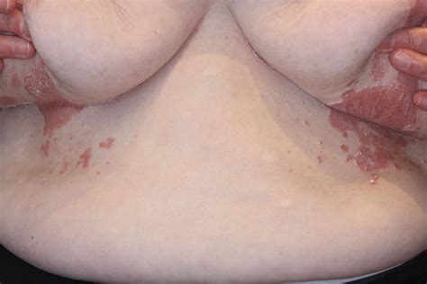 Intertriginöse Candidadermatitis Doccheck