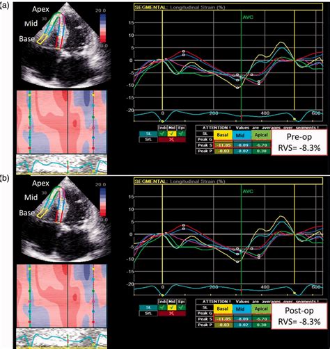 An Illustration Of RV Strain Measurement Prior To And Post MV Repair Download Scientific Diagram