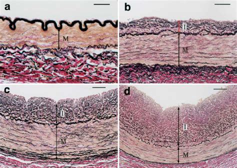 Diffuse Intimal Thickening DIT In Proximal Coronary Arteries Download Scientific Diagram