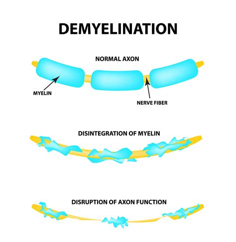 Trigeminal Neuralgia Causes Symptoms And Treatments