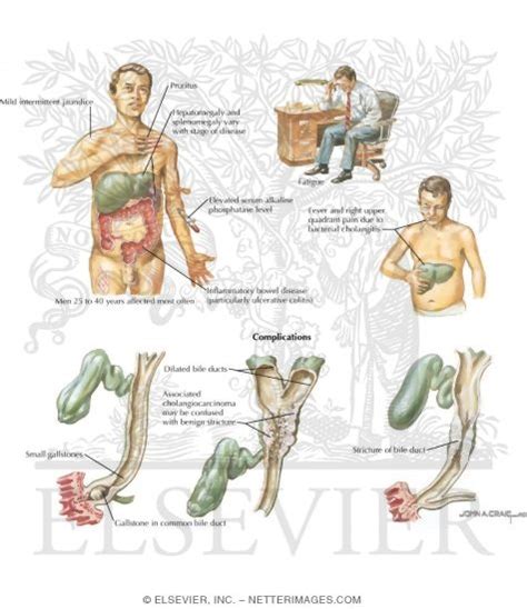 Clinical Manifestations Of Primary Sclerosing Cholangitis
