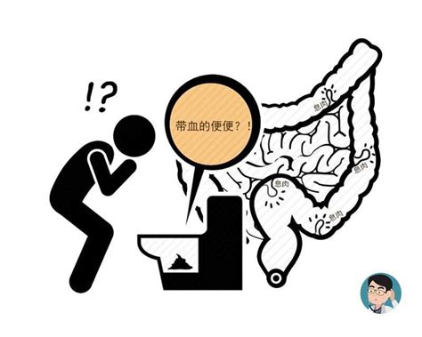 哪些息肉有癌變傾向？提醒：三種類型要警惕，有3個異常儘快切除 壹讀