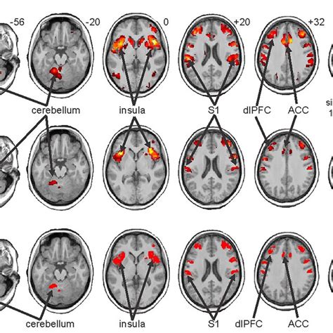 Signal Intensity Increases Hot Color Scale Overlaid Onto Axial Slices Download Scientific