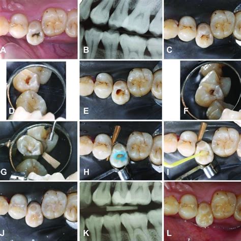Pdf Conservative Composite Resin Restoration For Proximal Caries Two Case Reports