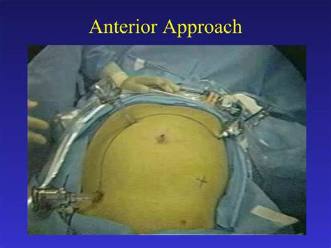 Laparoscopic Colon Resection Anterior Approach Ppt