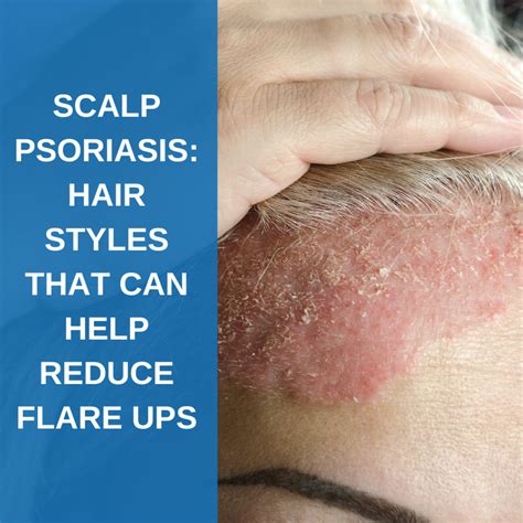 7 Psoriasis Scalp Home Remedies Relief And Management Tips