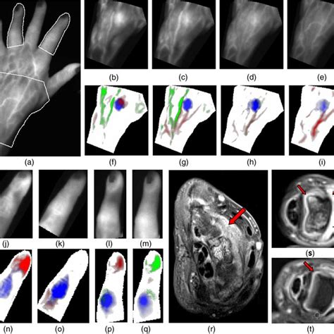 Fluorescence Image In The Mcp Area Of A Patient With Moderate Synovitis Download Scientific